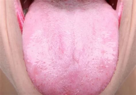 What Does Anorexia Teeth Look Like 7 Important Tips