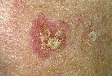 Actinic Keratosis Pictures Causes Symptoms And Treatment