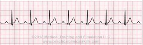 Rhythm Strip Analysis Flashcards Quizlet