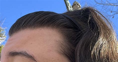 Ive Always Had A Front Cowlick But My Left Temple Used To Look Like My Right One Two Years Ago