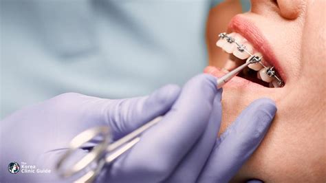 Clippy C Braces In Korea Best Clinics Costs Procedure Types And More