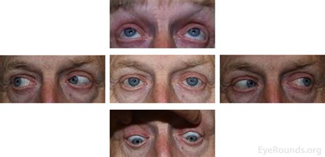 Self Resolving Ischemic Third Nerve Palsy