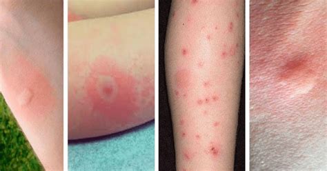Spruce Bug Bite