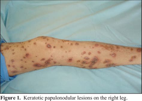 Dermatologic Complications Semantic Scholar