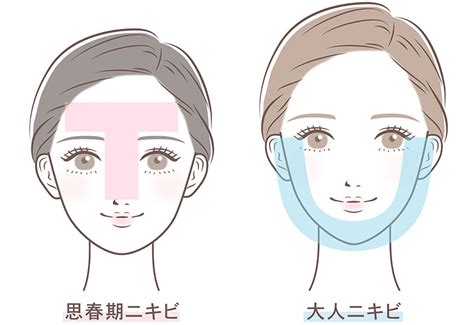 にきび治療（保険適用）は池袋皮膚科｜平日21時まで｜ニキビ跡