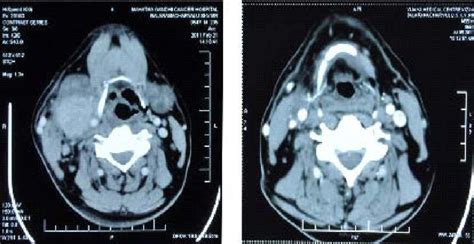 A Pretreatment Cect Of Neck Showing Right Upper Cervical Lymph Node