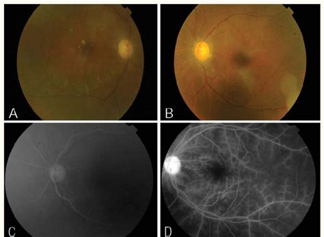 Aandb Color Fundus Photographs Of The Right And Left Eyes Respectively