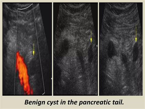 Ultrasound Of Pancrease In Radiology Pptx