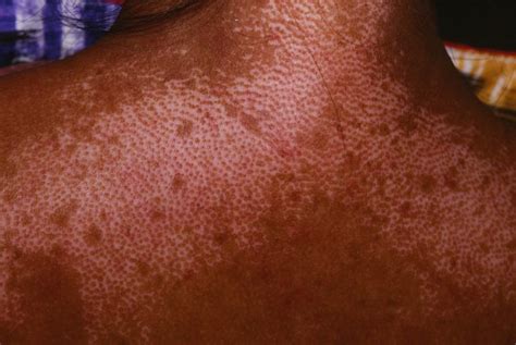 Scleroderma Causes Symptoms Prognosis Diagnosis Treatment