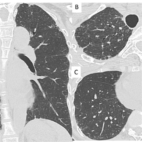 Flow Sheet Ild Interstitial Lung Disease Ppfe Pleuroparenchymal