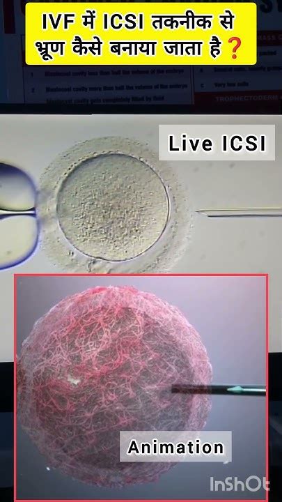 Live Icsi Process In Ivf Treatment Intracytoplasmic Sperm Injection Ivf Ivftreatments Icsi
