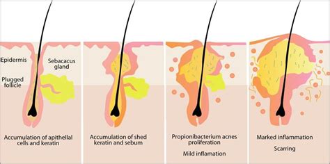 Health Girl Zits Secrets And Techniques