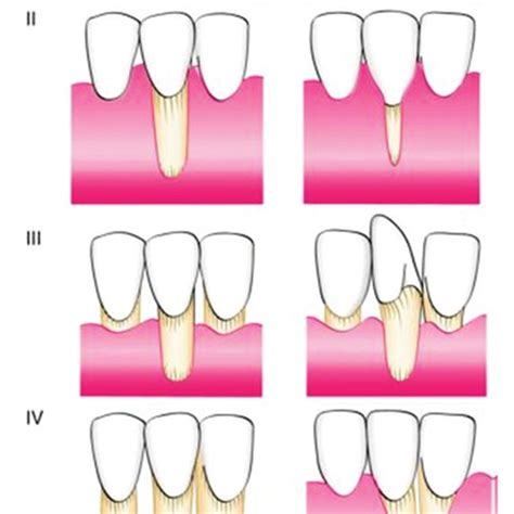 Pdf Classification Systems Of Gingival Recession An Update