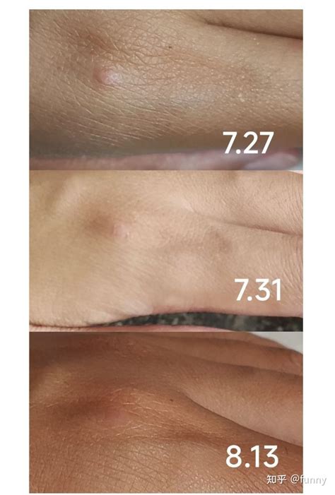 记录一下，看扁平疣的经历。 知乎