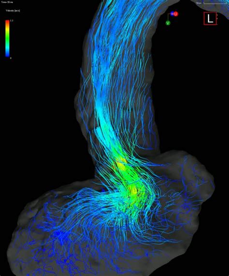 Cardio Flow Design Inc On Linkedin Blood Flow Of Aortic Valve Disease