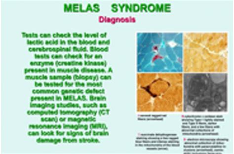 Melas Syndrome