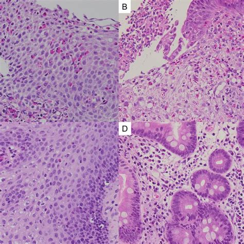 Pathological Findings Of The Biopsy Tissue Of Esophagus And Duodenum