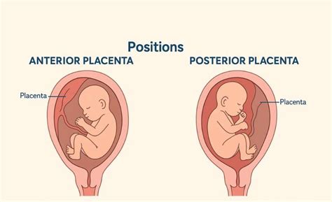Difference Between Anterior And Posterior Placenta A Detailed Guide By Dr Nehal Dhaduk