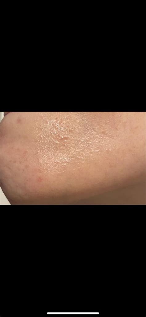 Treatment Resistant Perioral Dermatitis Is It A Permanent Comorbidity To Rosacea Rrosacea