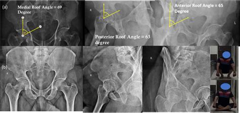 Roof Angle Acetabular 12300 About Roof