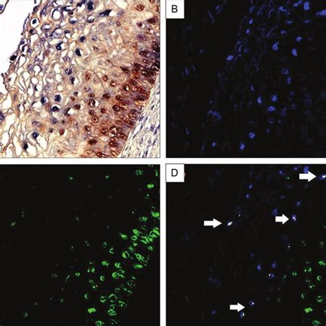 Co Expression Analysis Of P16 Ink4a And Human Papilloma Virus Hpv Dna
