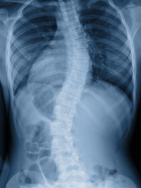 Scoliosis Diagnosis