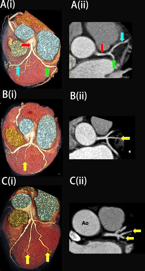 The Influence Of The Presence Of The Ramus Intermedius On