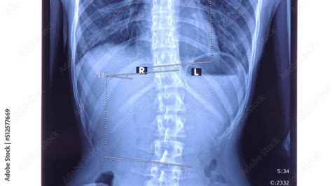 X Ray Of The Spine Showing Scoliosis In The Lumbar Area Scoliosis Is