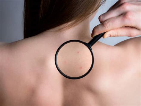 Confront The Acne On Your Back Backne Amber Beila Beauty Pte Ltd