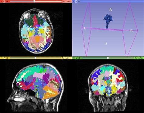 Segmentation Of Normal Brain Mr Image Data Download Scientific Diagram