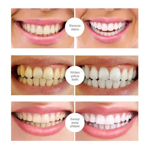 Teeth Whitening Antibiotic Staining