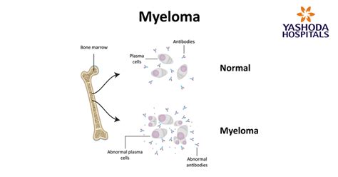 Bone Marrow Transplantation For Non Hodgkins Lymphoma