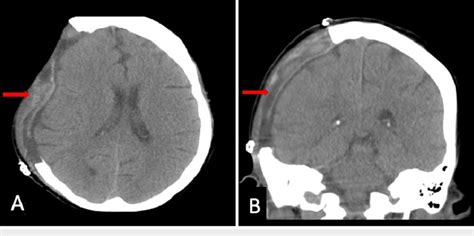 Non Contrast Ct Head Post Right Hemicraniectomy Red Arrows Indicate