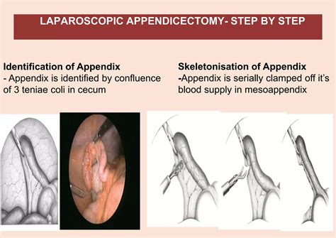 Acute Appendicitis Appendicectomy Open And Laparoscopicpdf