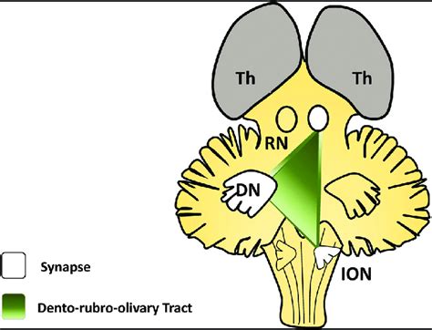 Diagram Of The Guillain Mollaret Triangle The Dento Rubro Olivary