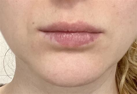 My Under Lip Is Missing Pigmentation Rmildlyinteresting