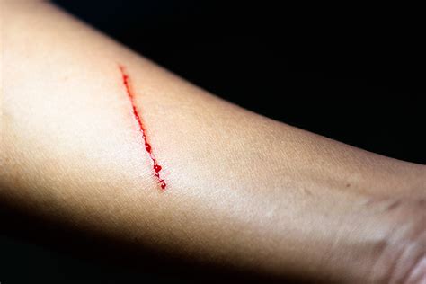 Assault Occasioning Actual Bodily Harm Aoabh Nsw Criminal Law Guide