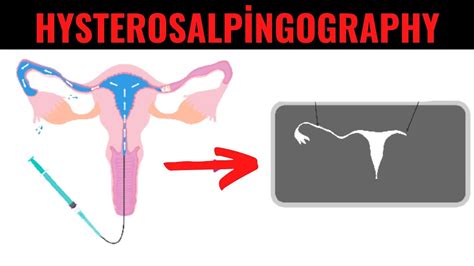 Hysterosalpingography Youtube