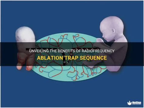 Unveiling The Benefits Of Radiofrequency Ablation Trap Sequence Medshun