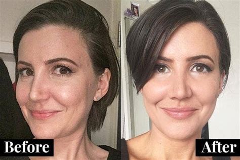 What Is A Liquid Facelift Before After Pics Of The Cosmetic Procedure Yourtango