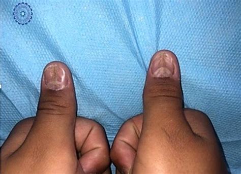 Median Nail Dystrophy Of The Thumb Nail In Bilateral Download