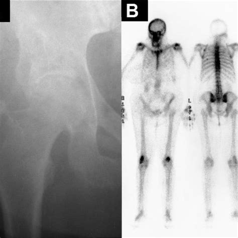A X Rays Detected An Expansive Osteolytic Lesion Of The Right