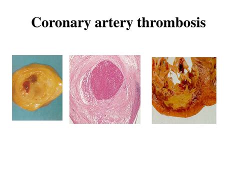 Ppt Thrombosis And Embolism Powerpoint Presentation Free Download
