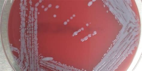 Caso De Epidermitis Exudativa Zenit