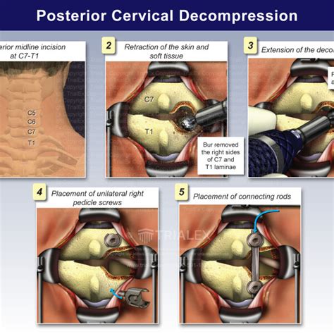 Lumbar Decompression And Interbody Fusion Trial Exhibits Inc