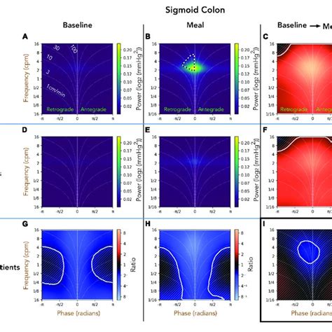 1 H Examples Of High Resolution Colonic Manometry Traces Recorded In Download Scientific