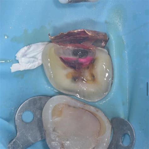 Cavities With Cracks In Teeth — Alleman Center Of Biomimetic Dentistry