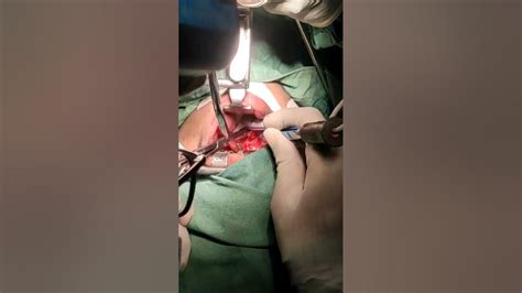 My Operation Tonsils Youtube