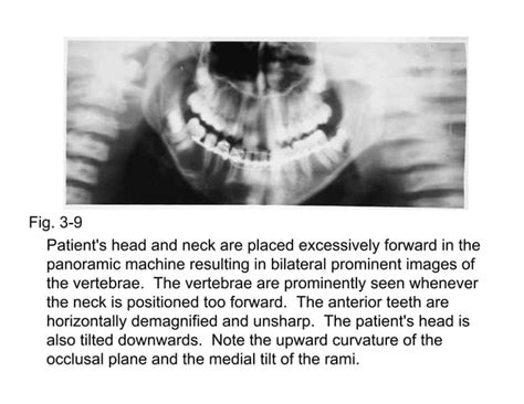 Positioning Errors In Panoramic Radiography Ppt