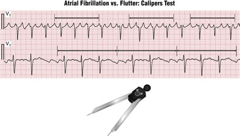 Atrial Fibrillation V Flutter